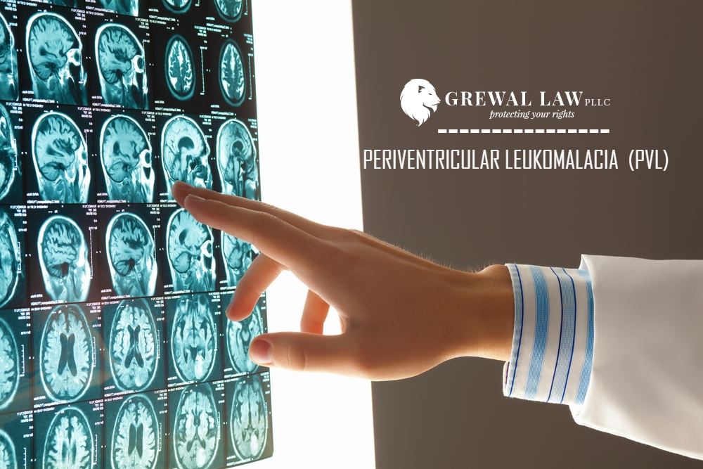 What Is Periventricular Leukomalacia (PVL)? | Grewal Law PLLC